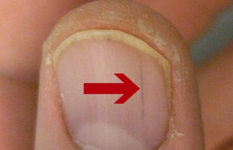 15 Signes Sur Votre Santé Que Vos ongles Peuvent Vous Révéler... Bon À ...